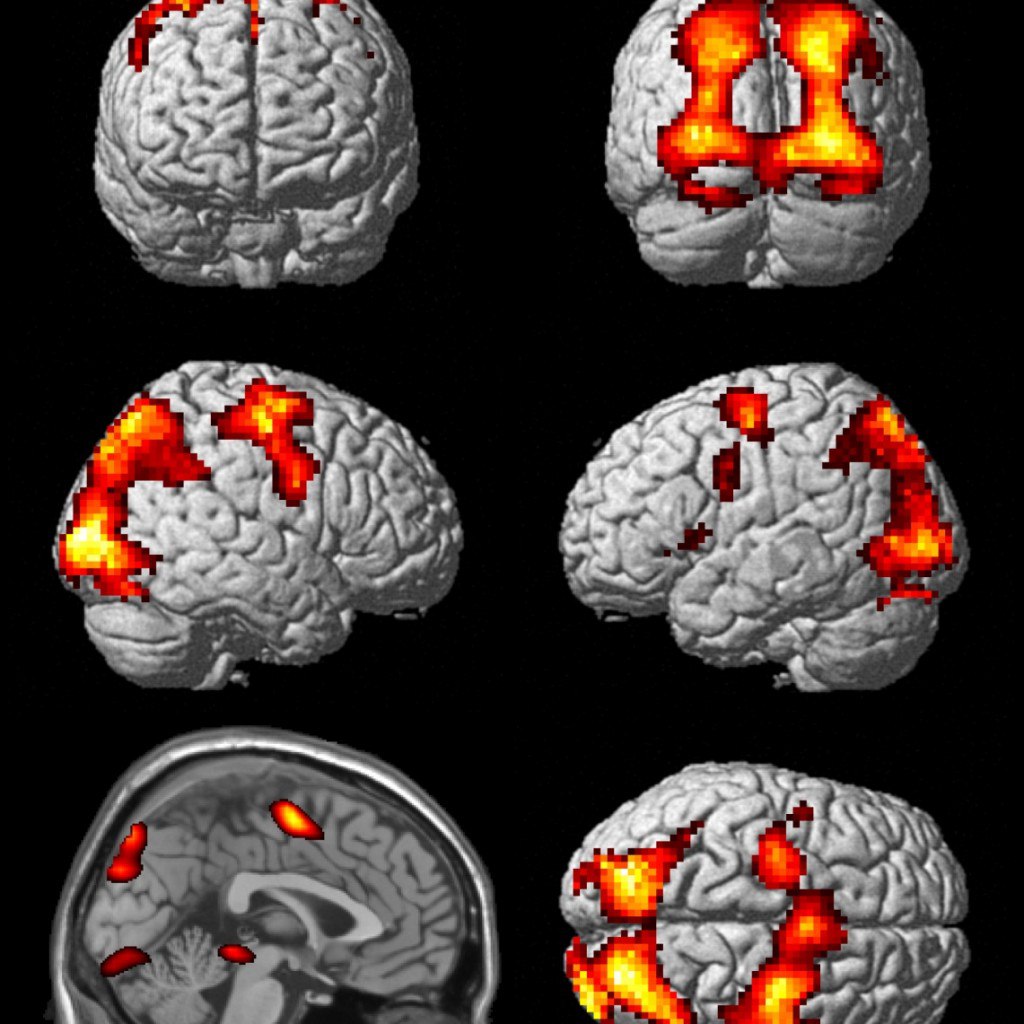 FNCI Brain Scan Benefits Concussion Treatment fnci-brain-scan-benefits-concussion-treatment