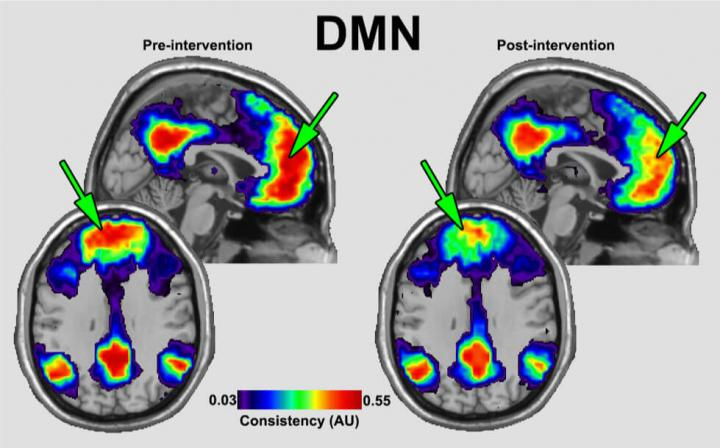 Post-Concussion Syndrome: Why Your Symptoms Linger & How to Truly Recover