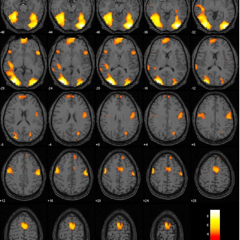 What is functional MRI and how is it different from other MRI Scans