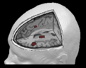 Diagnosing Concussion with functional NeuroCognitive Imaging | Cognitive FX