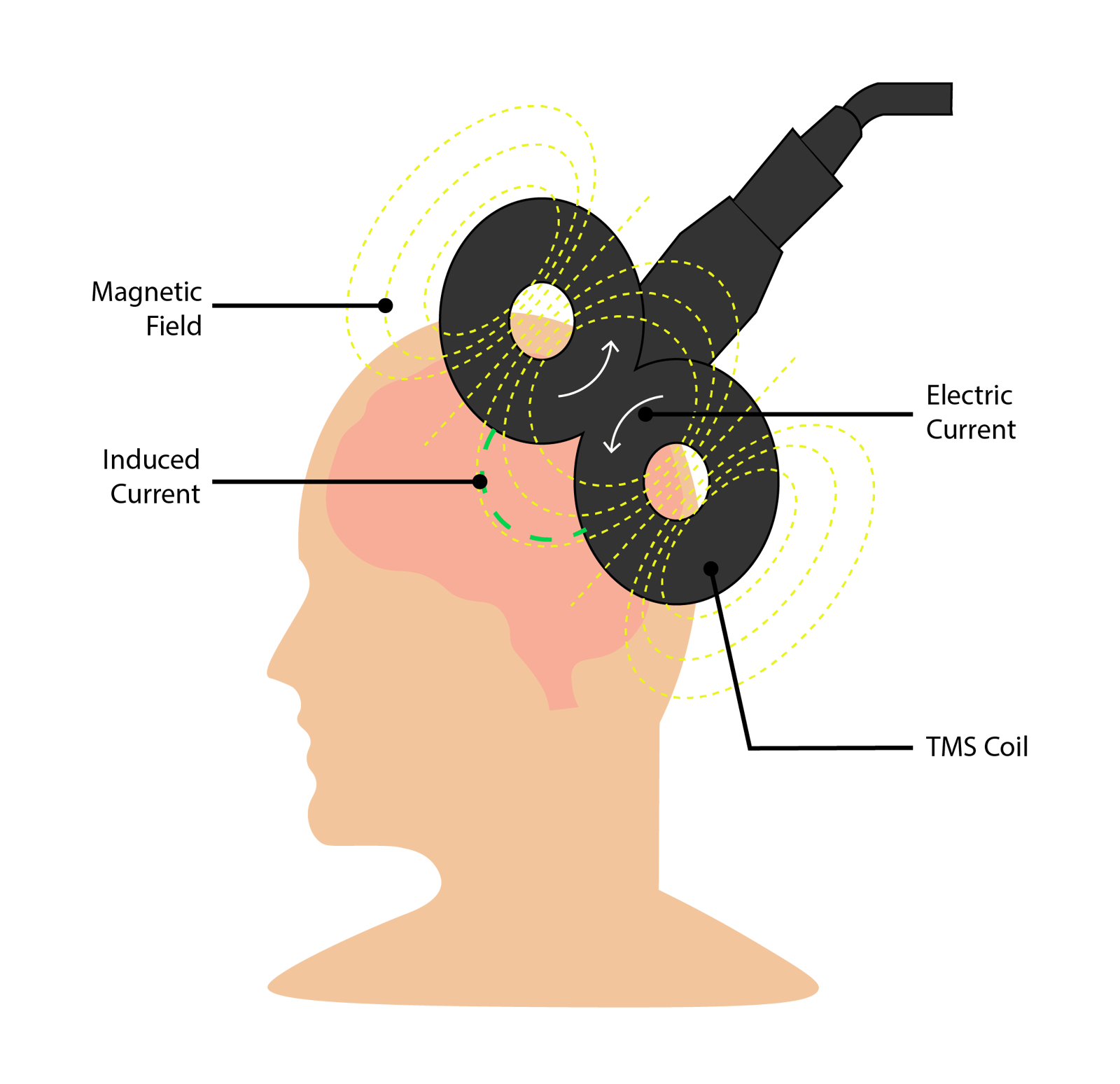 Precision Mental Health - fMRI Guided Transcranial Magnetic Stim