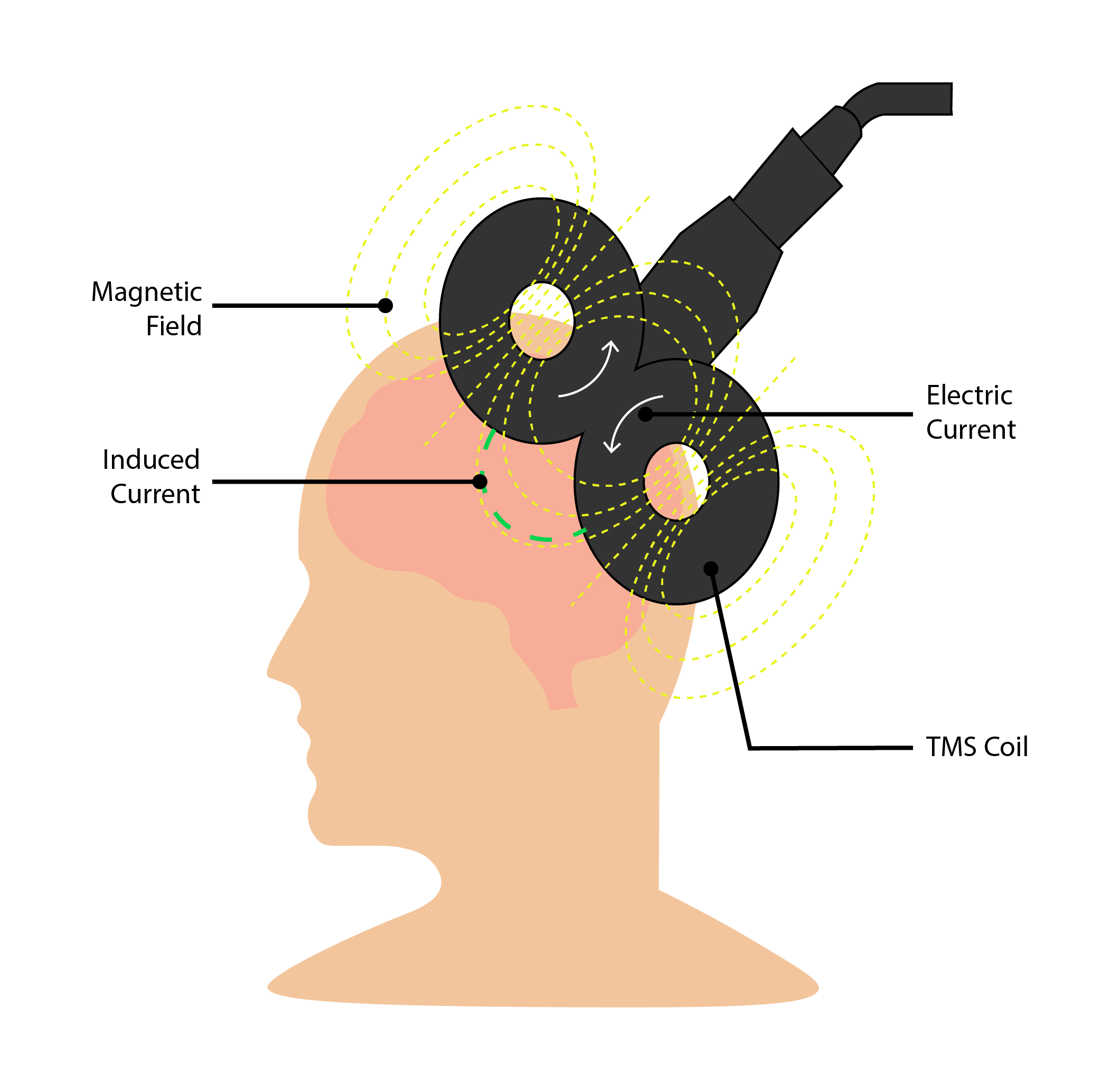 Precision Mental Health - fMRI Guided Transcranial Magnetic Stim