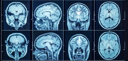 Do CT Scans Show Concussions or Post-Concussion Syndrome?