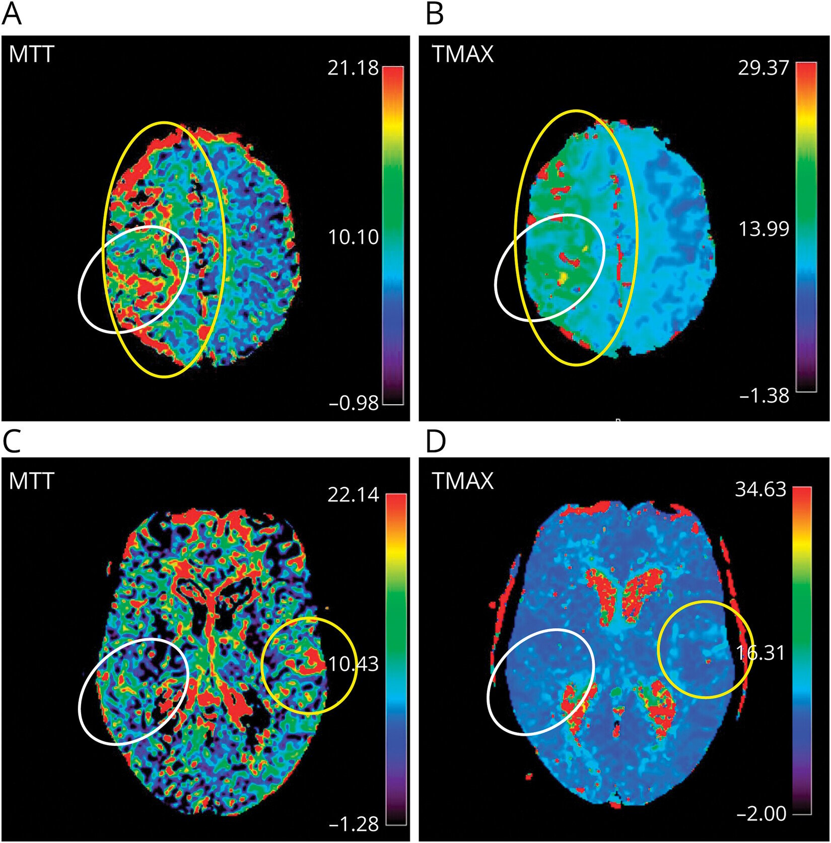 Cognitive Problems After TIA: Memory Loss, Brain Fog & Treatment Plans